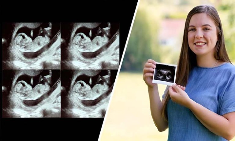 50 Million Views: A Rare Birth of Twins in Two Separate Uteruses - En ...