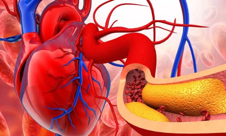 3 Symptoms That May Reveal Coronary Artery Blockage - En.ImArabic